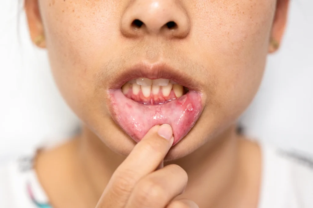 Understanding the Effects of Autoimmune Disorders on Oral Health ...